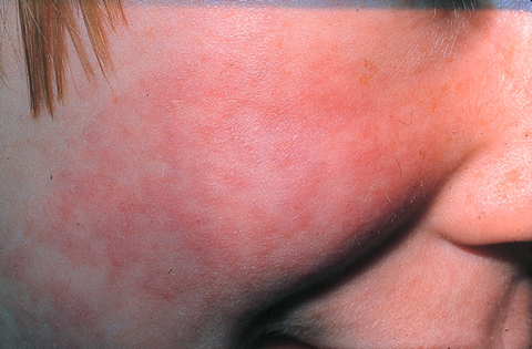 Éruption Maculopapulaire