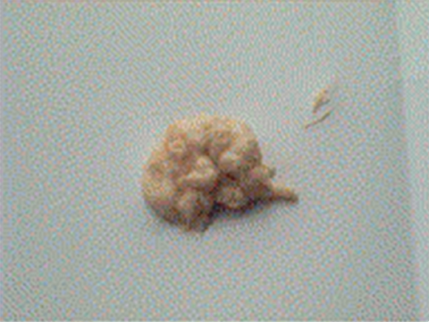 Ictère néonatal | www.pedia-univ.fr